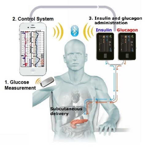 Apple-powered bionic pancreas one-step closer. | Fortune
