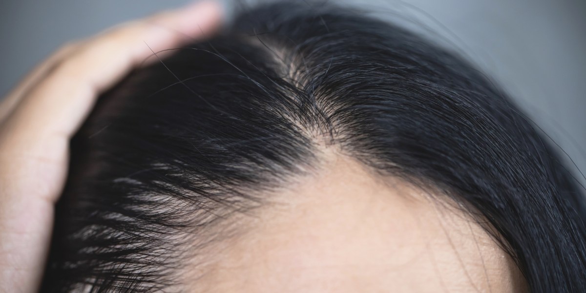 What you should know about PRP treatments for hair loss | Fortune