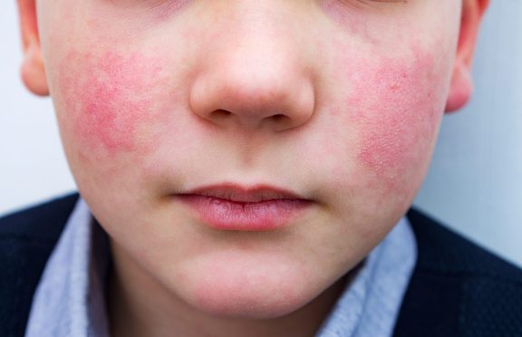 ‘Slapped cheek’ rash: Parvovirus B19 spread, symptoms, treatment for ...