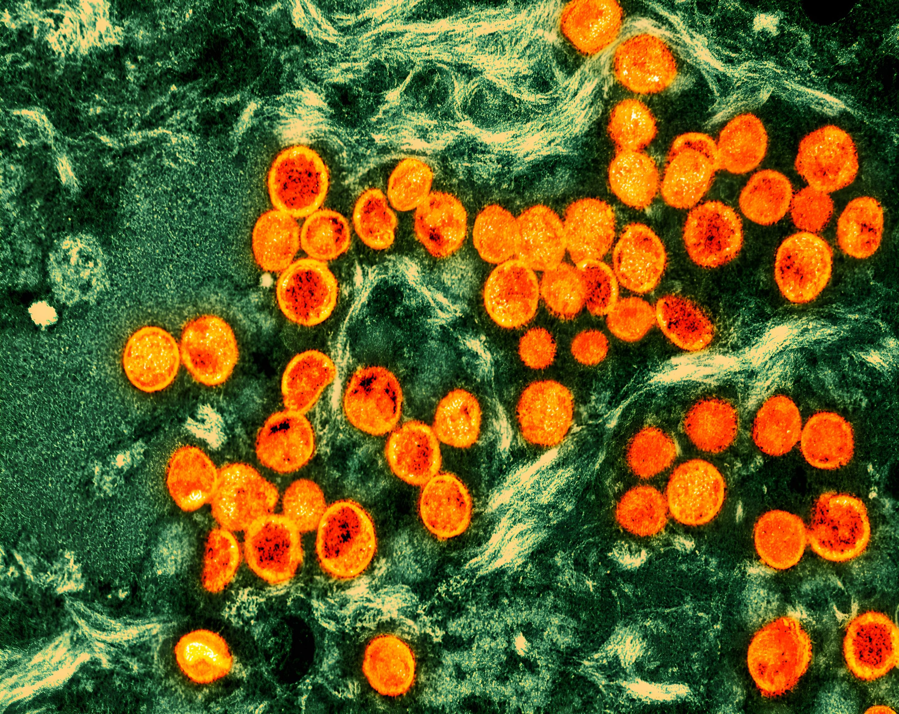 Sweden reports 1st case of more infectious form of mpox first ...
