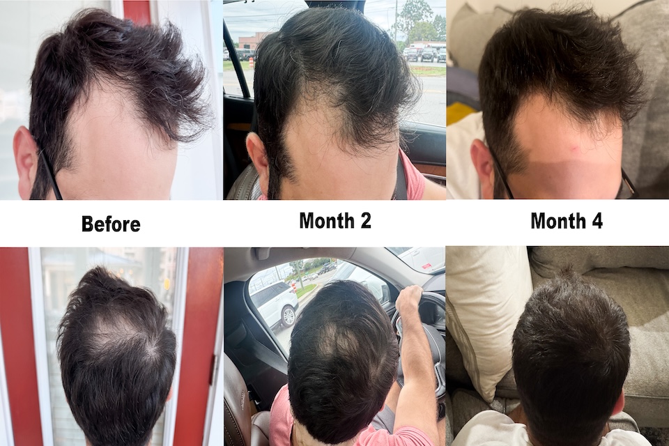 Hims Hair Loss Review (2026): Expert Approved | Fortune
